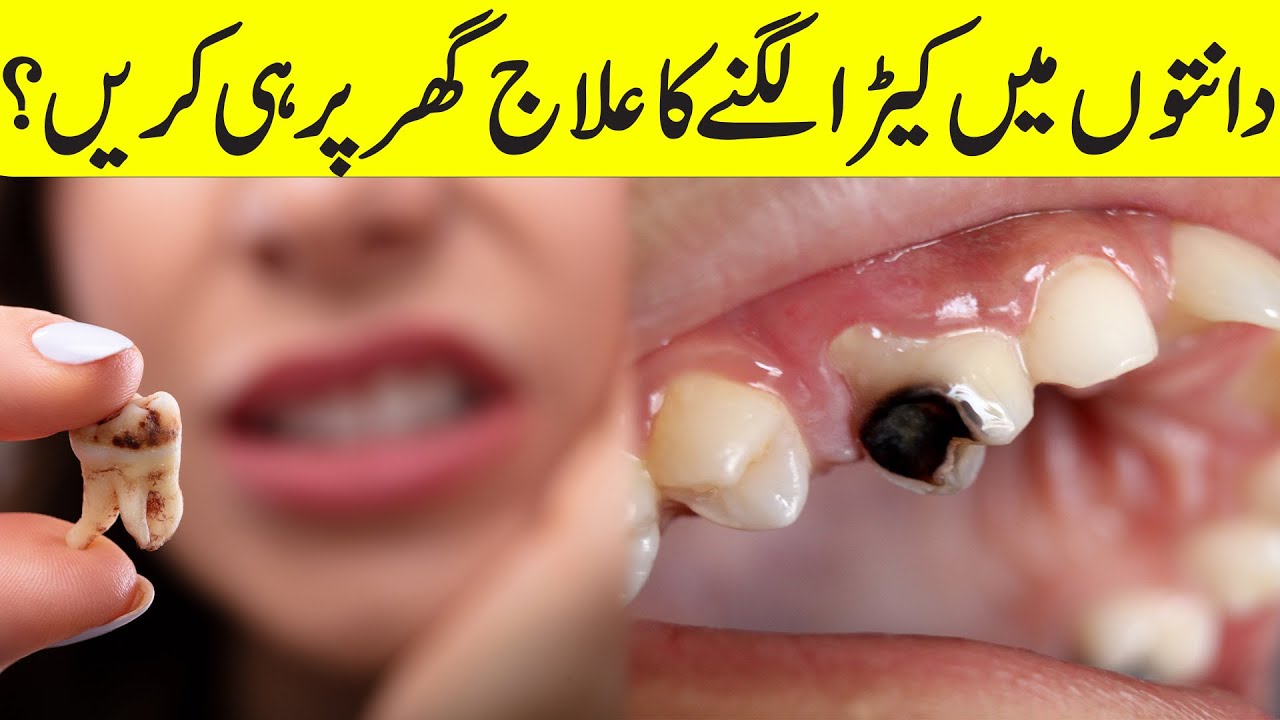 How To Reverse Tooth Cavities At Home With Enamel Repair Materials ...