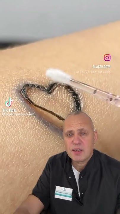 Ремувер или лазер ярославль лазерноеудаление Tattoo