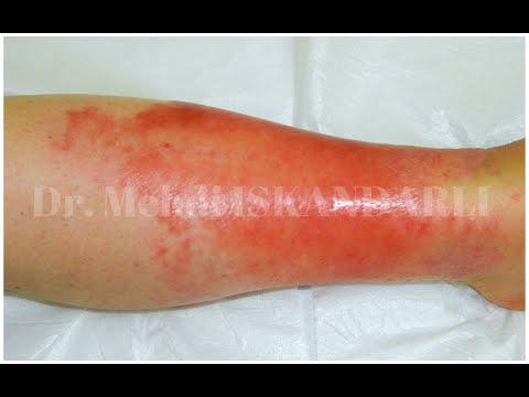 Qızıl yel xəstəliyi | Dermatoloq Mehdi İSKƏNDƏRLİ