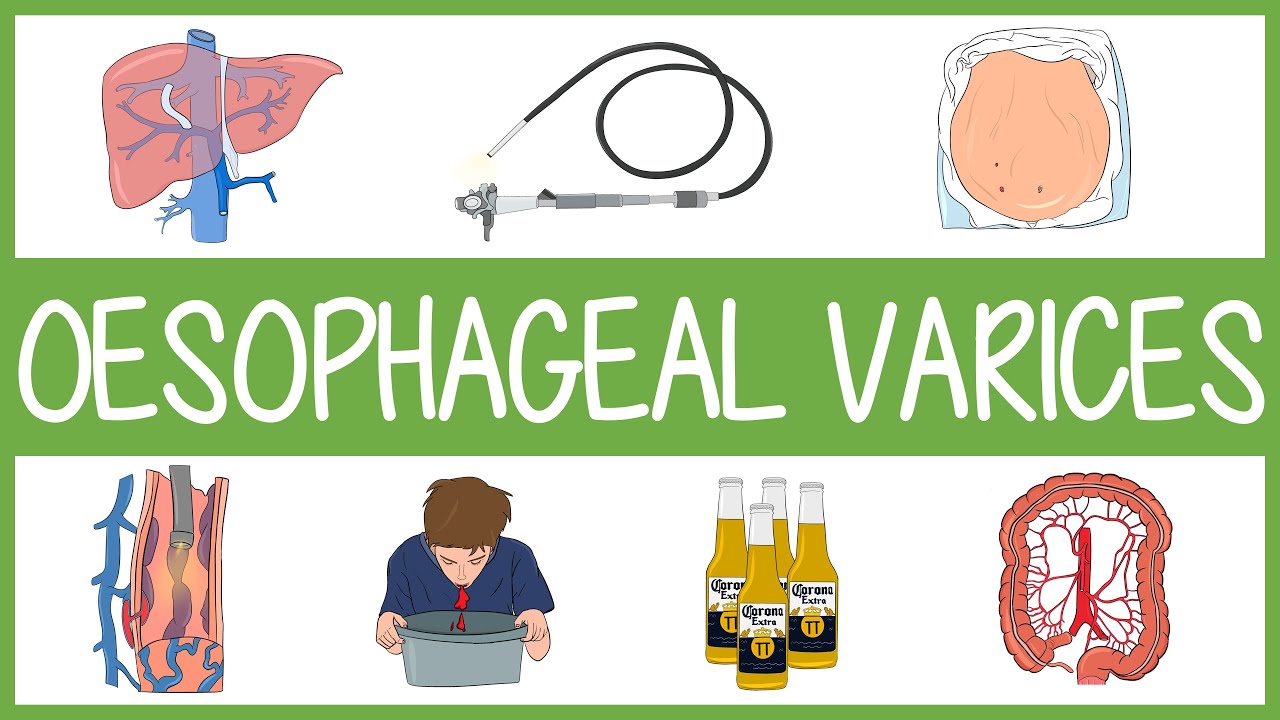 Oesophageal Varices Visually Explained - YouTube