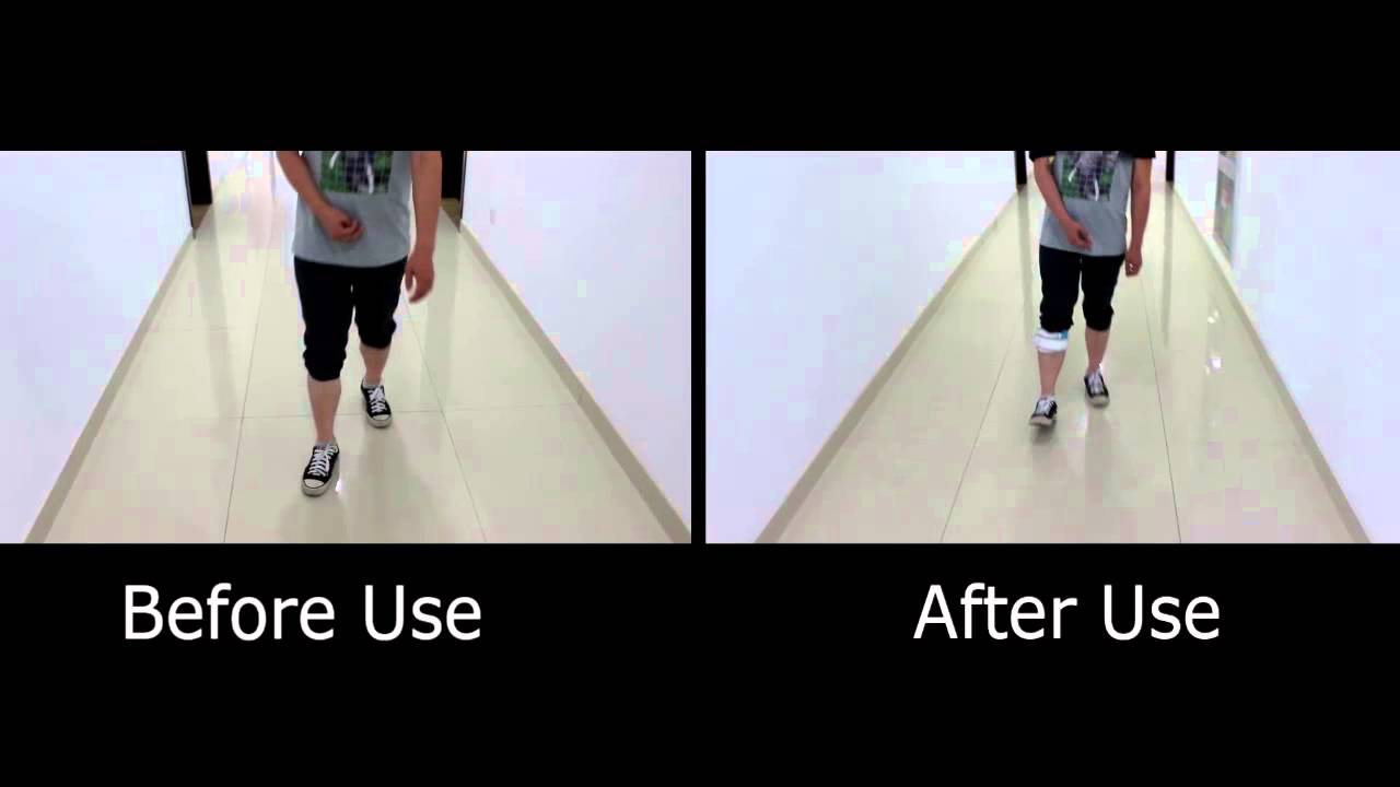 Aidus i-walk 200 Foot Drop System Compare - YouTube