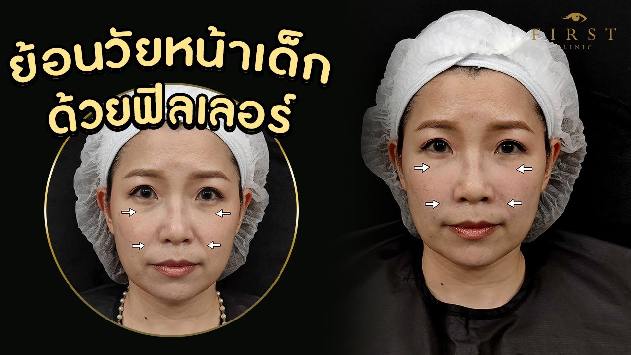 EP 62 : แก้ใต้ตาคล้ำ ร่องแก้ม สดใสทันที ลดอายุไปสิบปี! #2Madames - YouTube