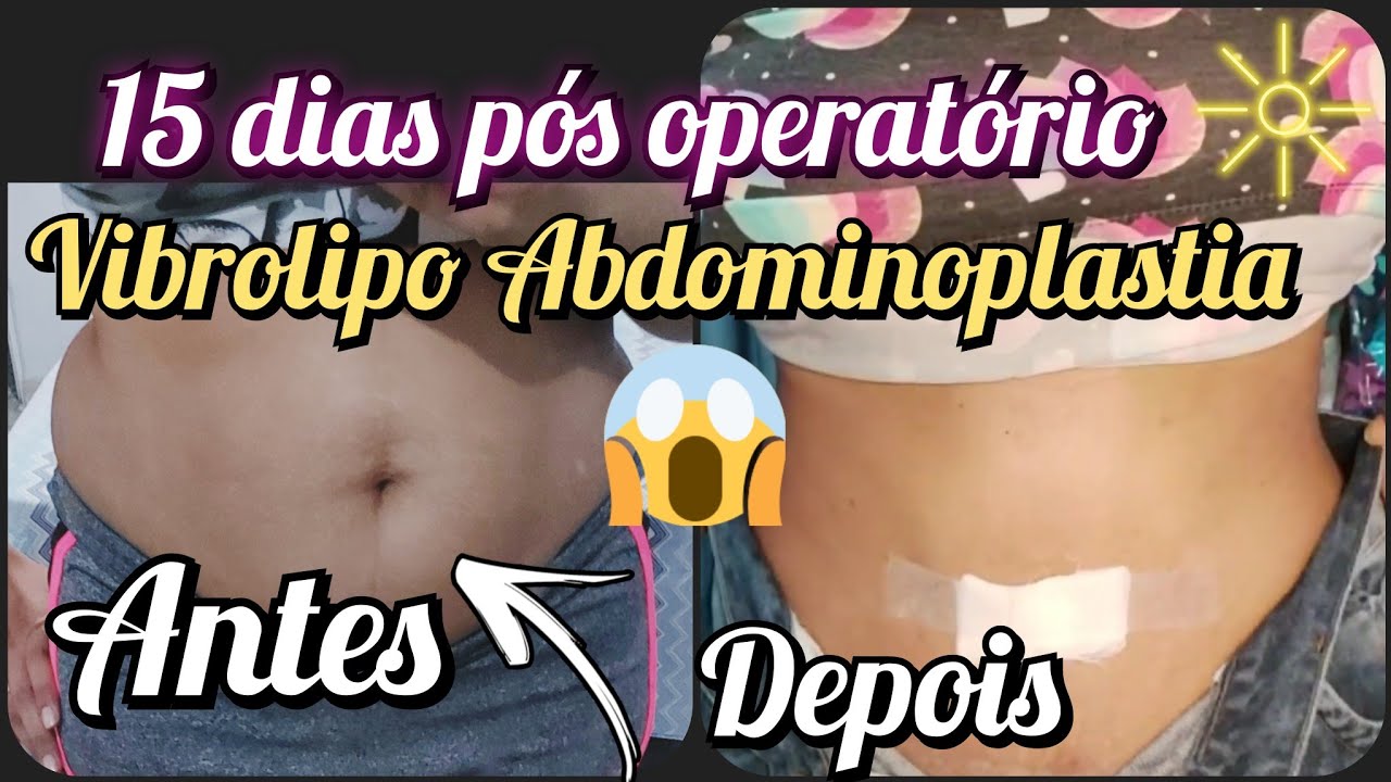 Diário de cirurgia/Antes e depois abdominoplastia com vibrolipo - YouTube