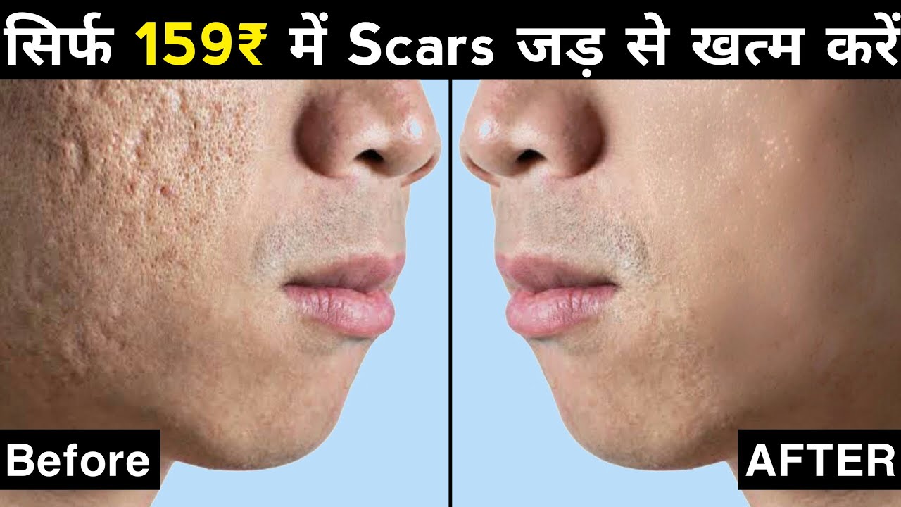 Acne Scars के 3 Treatment | How To Remove Pimples Holes, Scars [Hindi ...