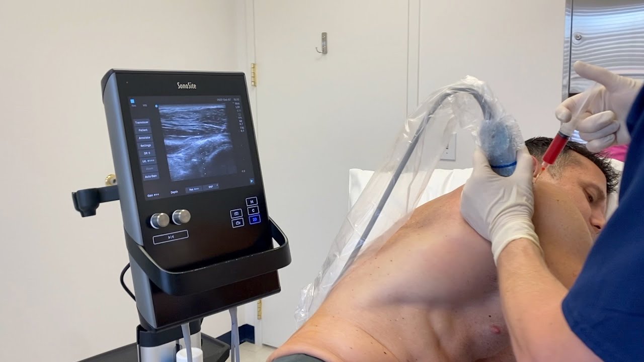 Shoulder Pain (Arthritis/Rotator Cuff Tear) Treatment with Bone Marrow ...