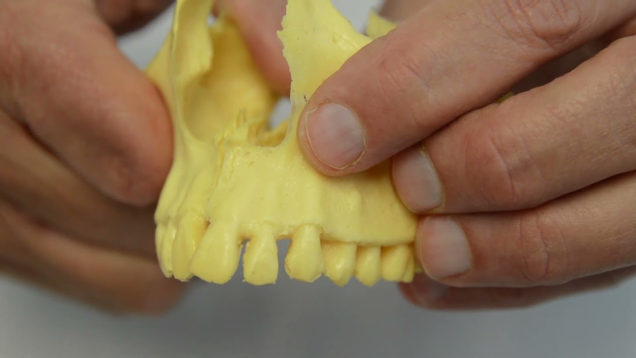 Maxilla Adjustment || Full HD - YouTube
