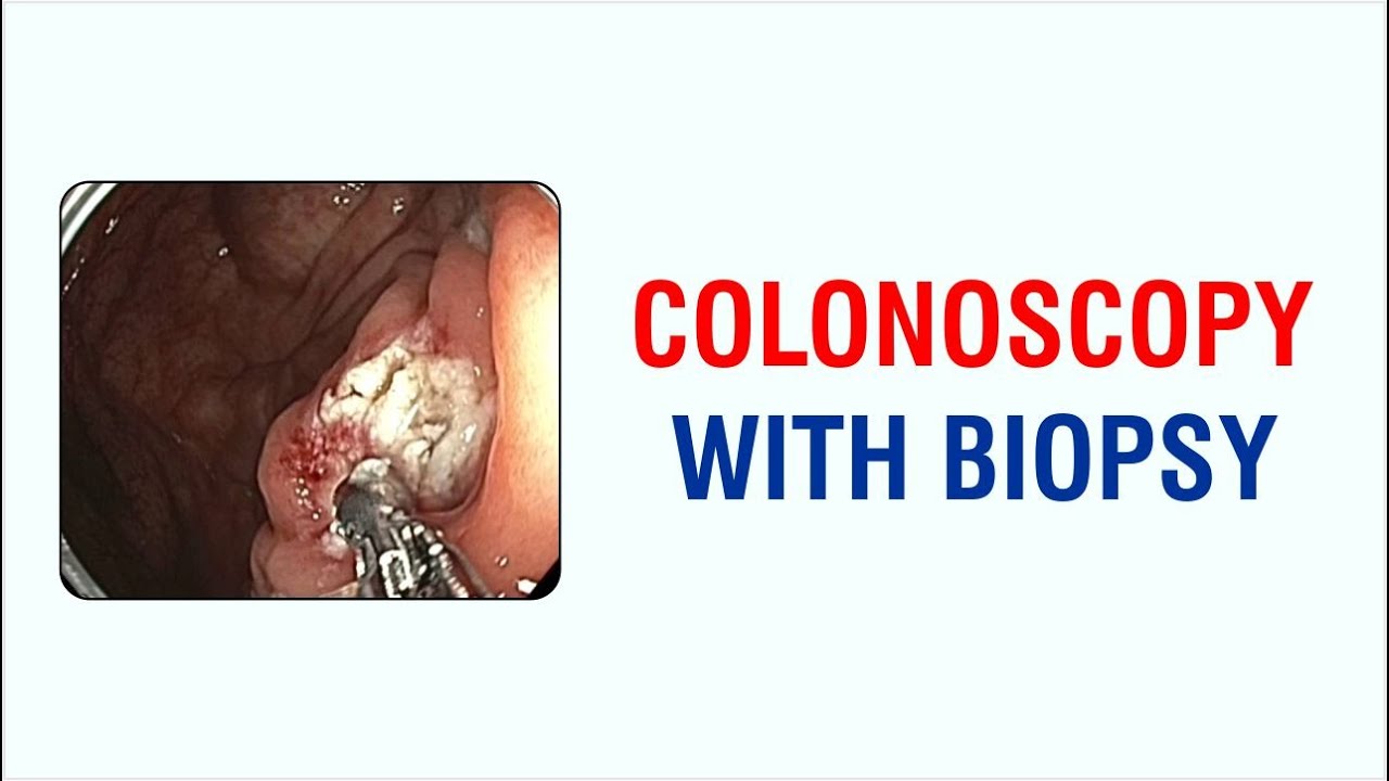 Colonoscopy with biopsy | Dr Rakesh Jha | Best Gastroenterologist ...