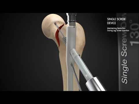 Smith & Nephew. Fractura pertrocantérica. Trigen InterTan - YouTube