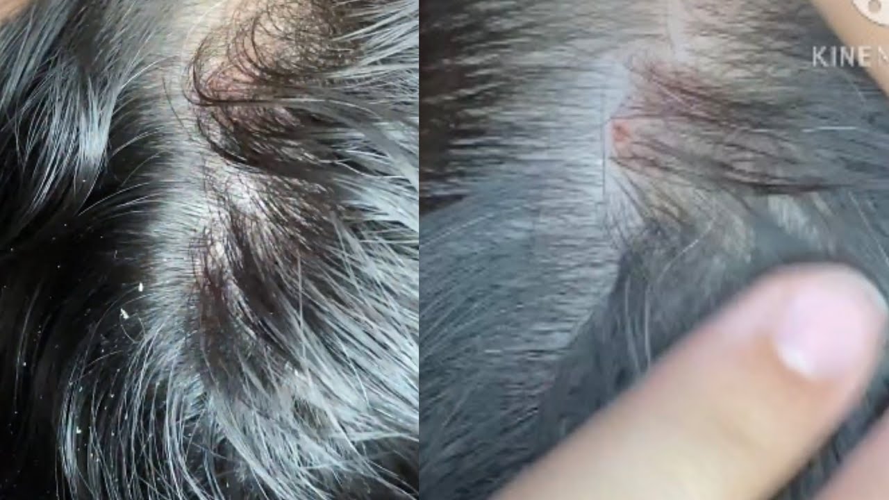 Dandruff Scratching, Scalp Check. (bleeding) - YouTube