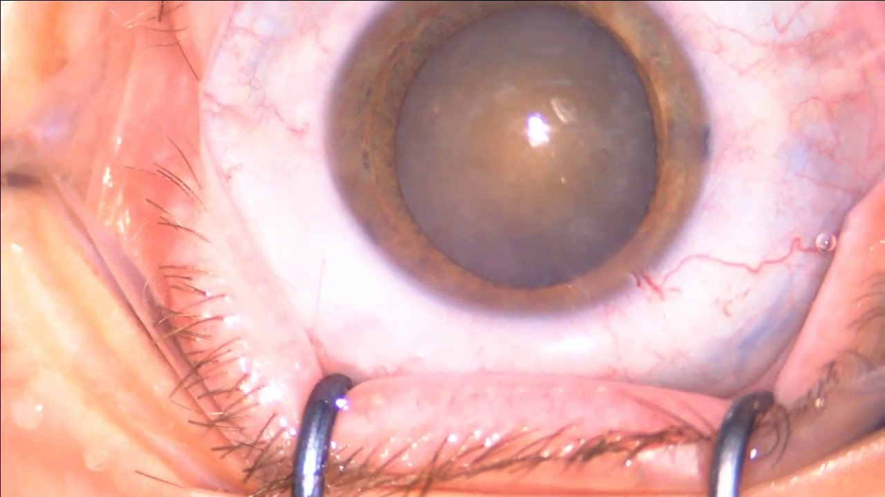 Brunescent cataract Lukan Mishev Live Stream - YouTube