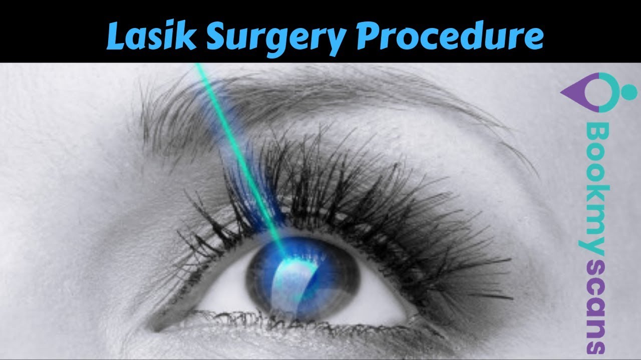 A Complete Step by Step Guide of Lasik Surgery | BookMyScans - YouTube