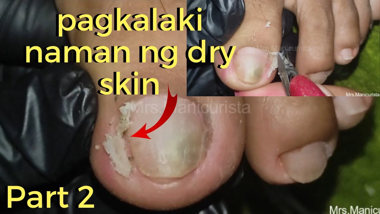 Vlog 683|Dry Skin/Ingrown Removal| PEDICURE 583 - YouTube