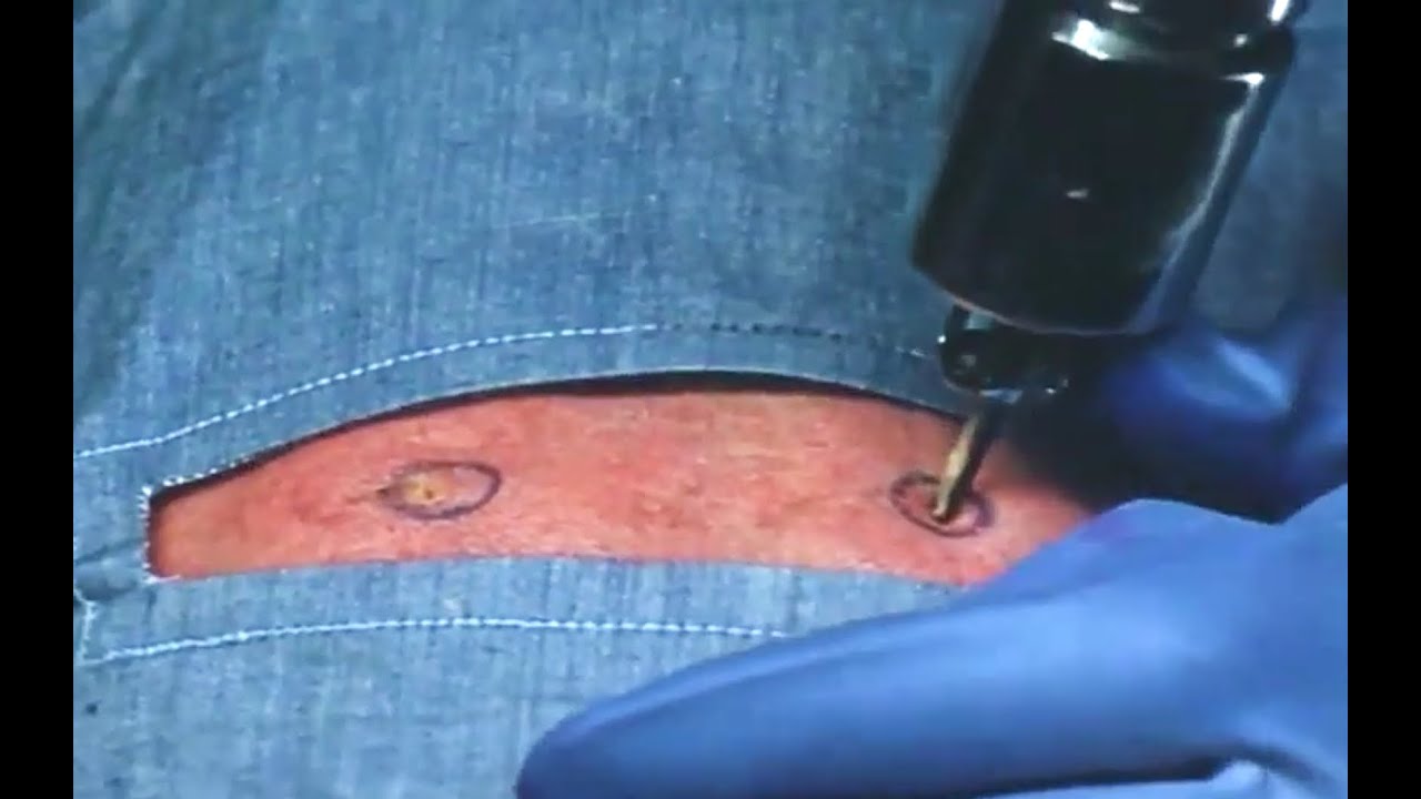 Trepanation / Trephination | Drilling Holes Into the Skull - YouTube