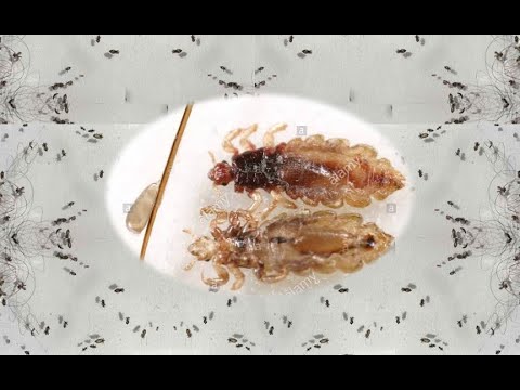 Home Remedies for Get Rid of Lice with Vinegar, Pictures of Dead Head ...