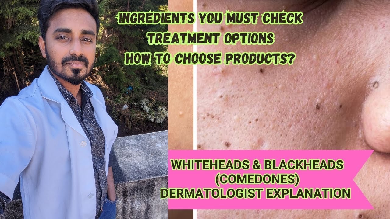 Whiteheads & Blackheads - Everything you must know| Comedones | Acne ...