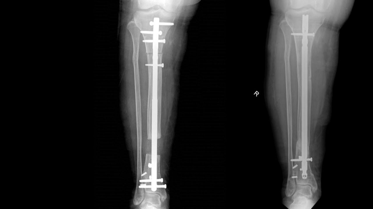 Stretching Bone Following Surgery to Correct Orthopedic Issues ...