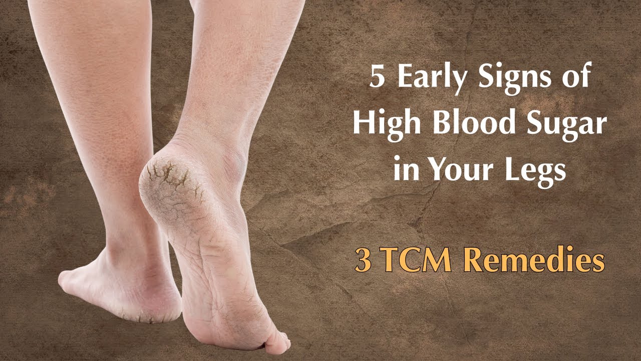 5 Early Signs of High Blood Sugar in Your Legs ｜ 3 TCM Remedy - YouTube
