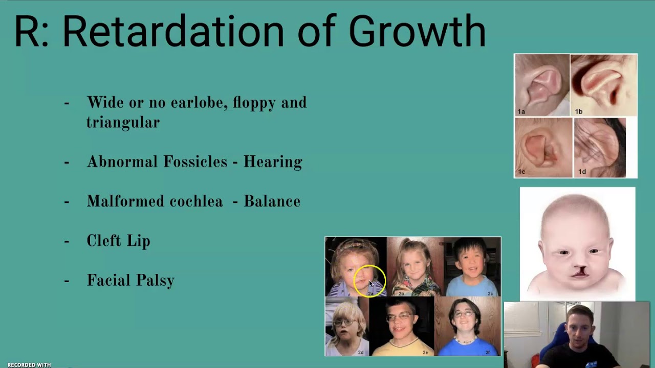 CHARGE Syndrome - Disability Project KRS 443 - YouTube