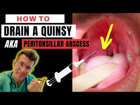 When To Drain Peritonsillar Abscess