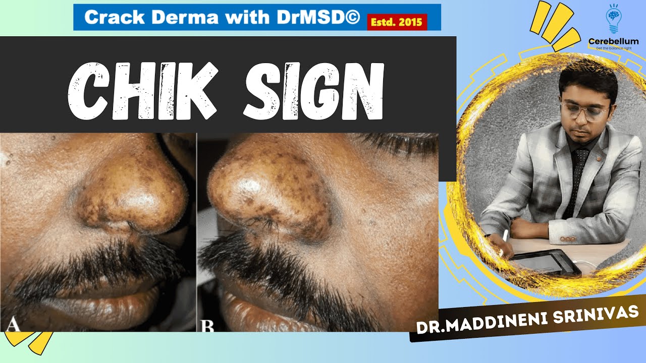 CHIK Sign explained by Dr Maddineni Srinivas - YouTube