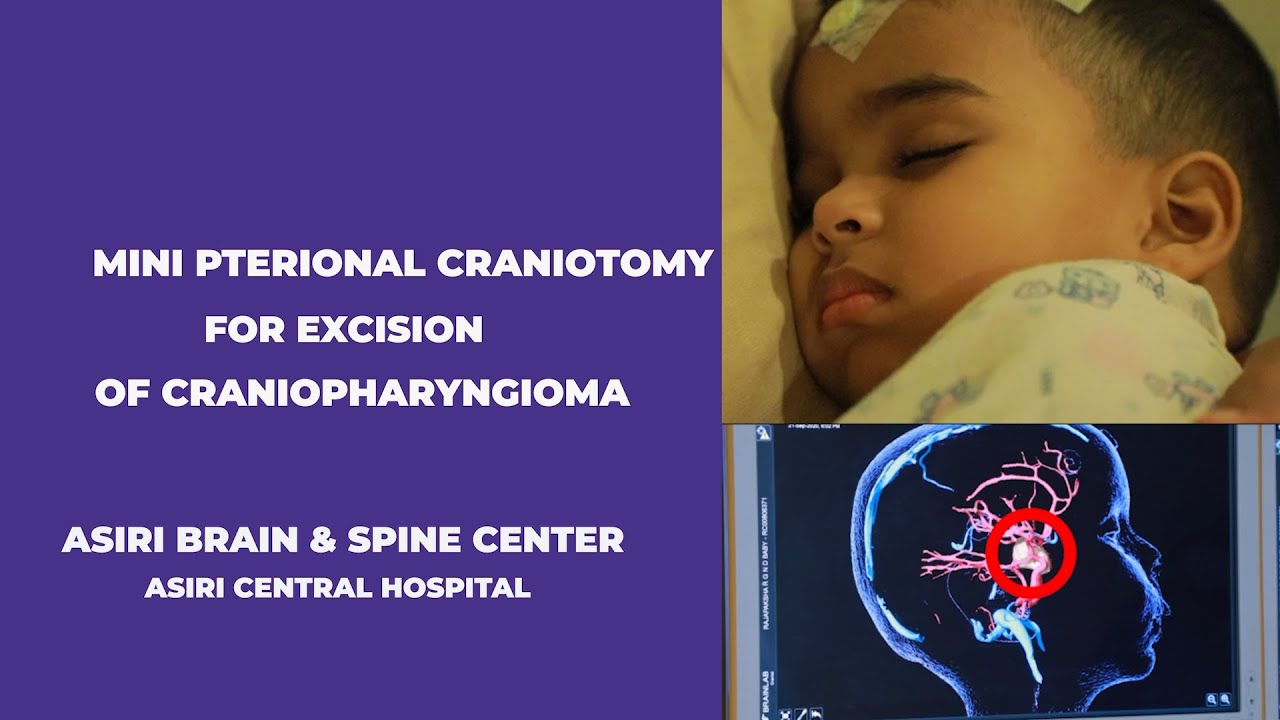 MINI PTERIONAL CRANIOTOMY FOR EXCISION OF CRANIOPHARYNGIOMA SURGERY ...