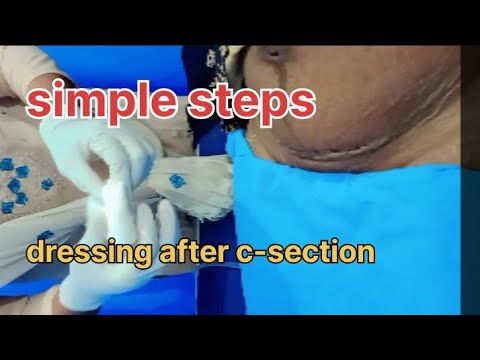 c section dressing karte huye ️#dressing kaise karte hai ##dressing ...