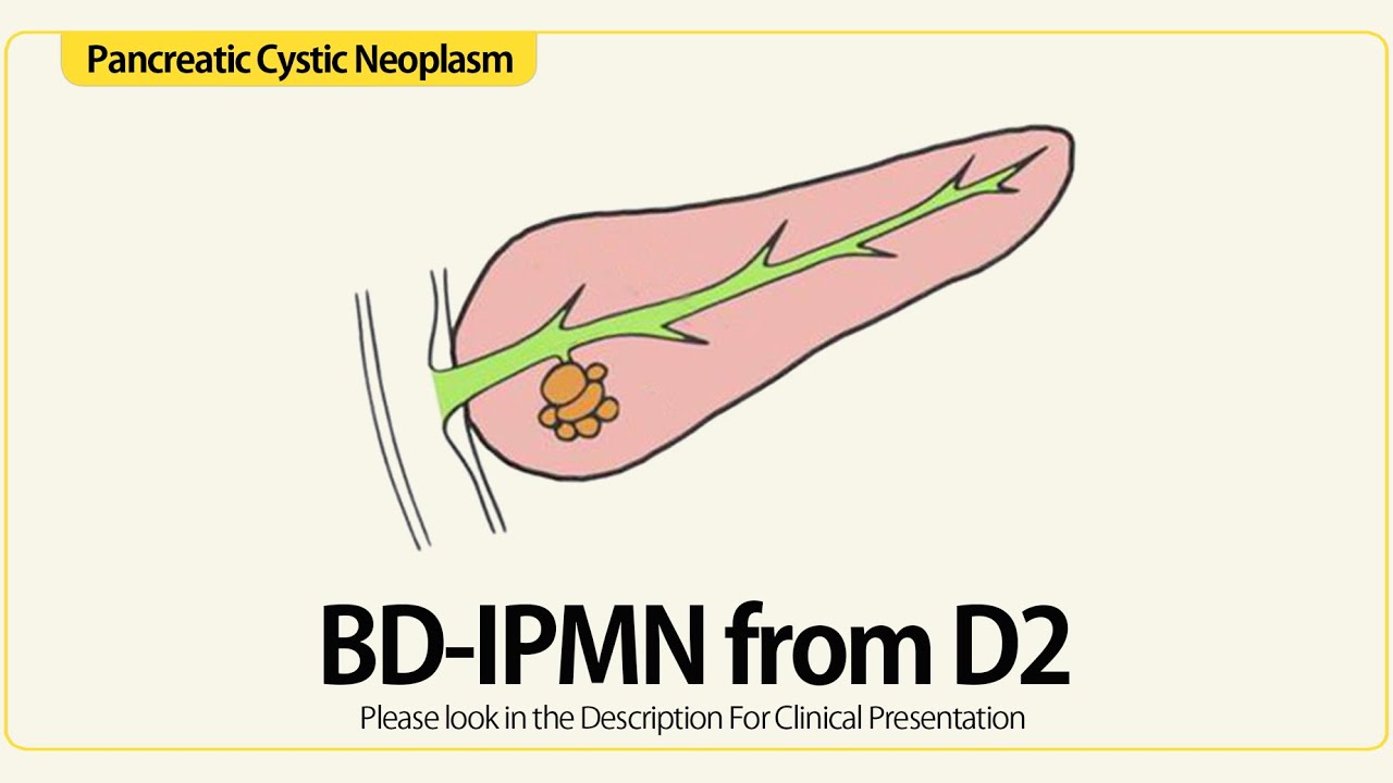 Linear EUS: BD-IPMN from D2 - YouTube
