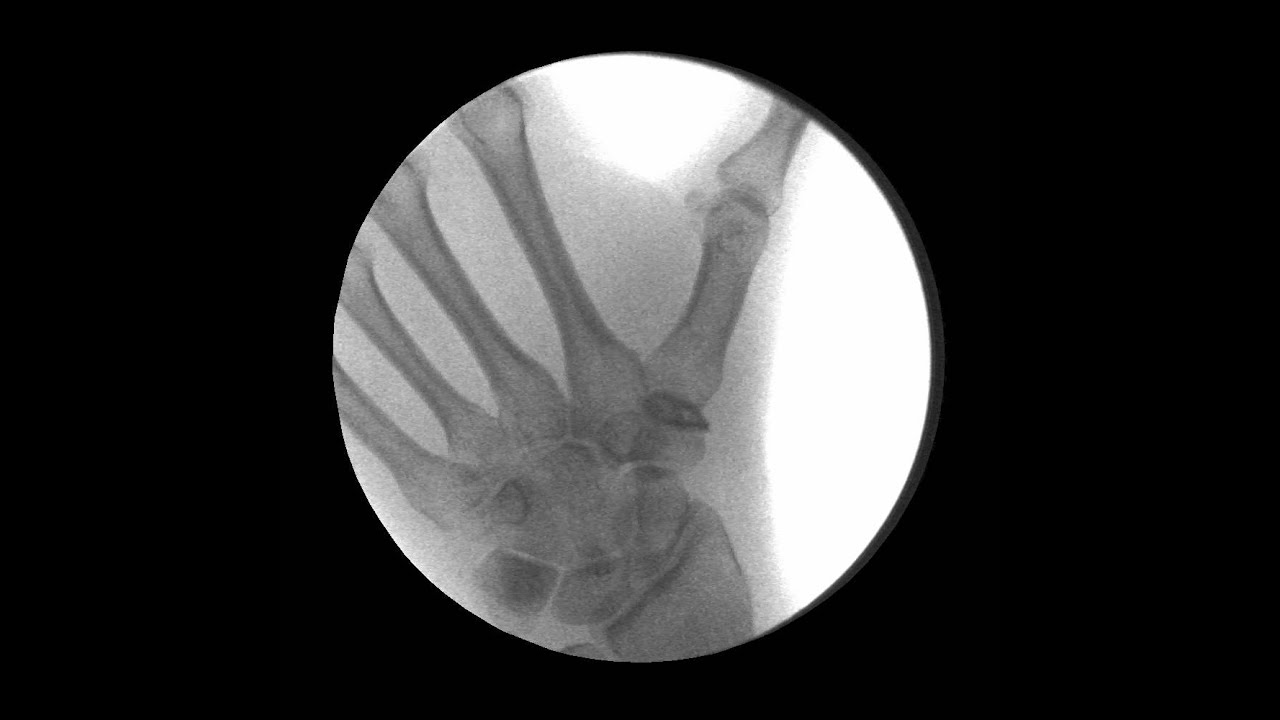 CMC replacement post-op x-ray video - YouTube