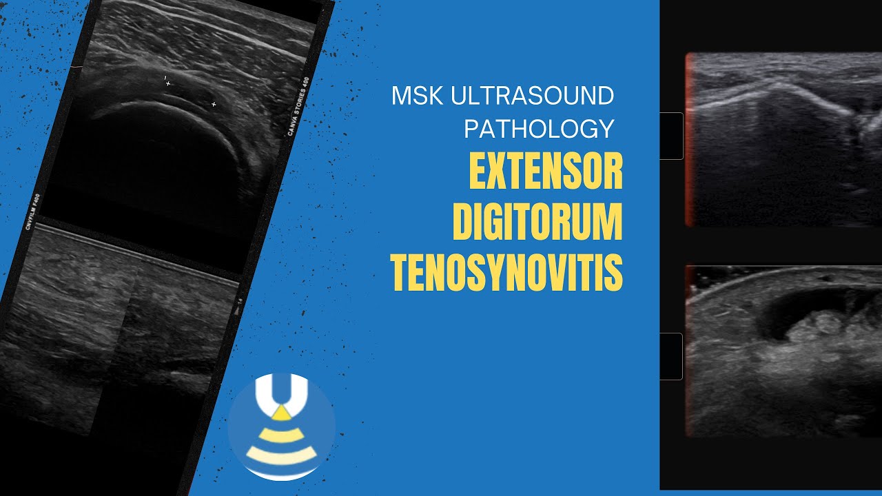 Extensor digitorum tenosynovitis - YouTube