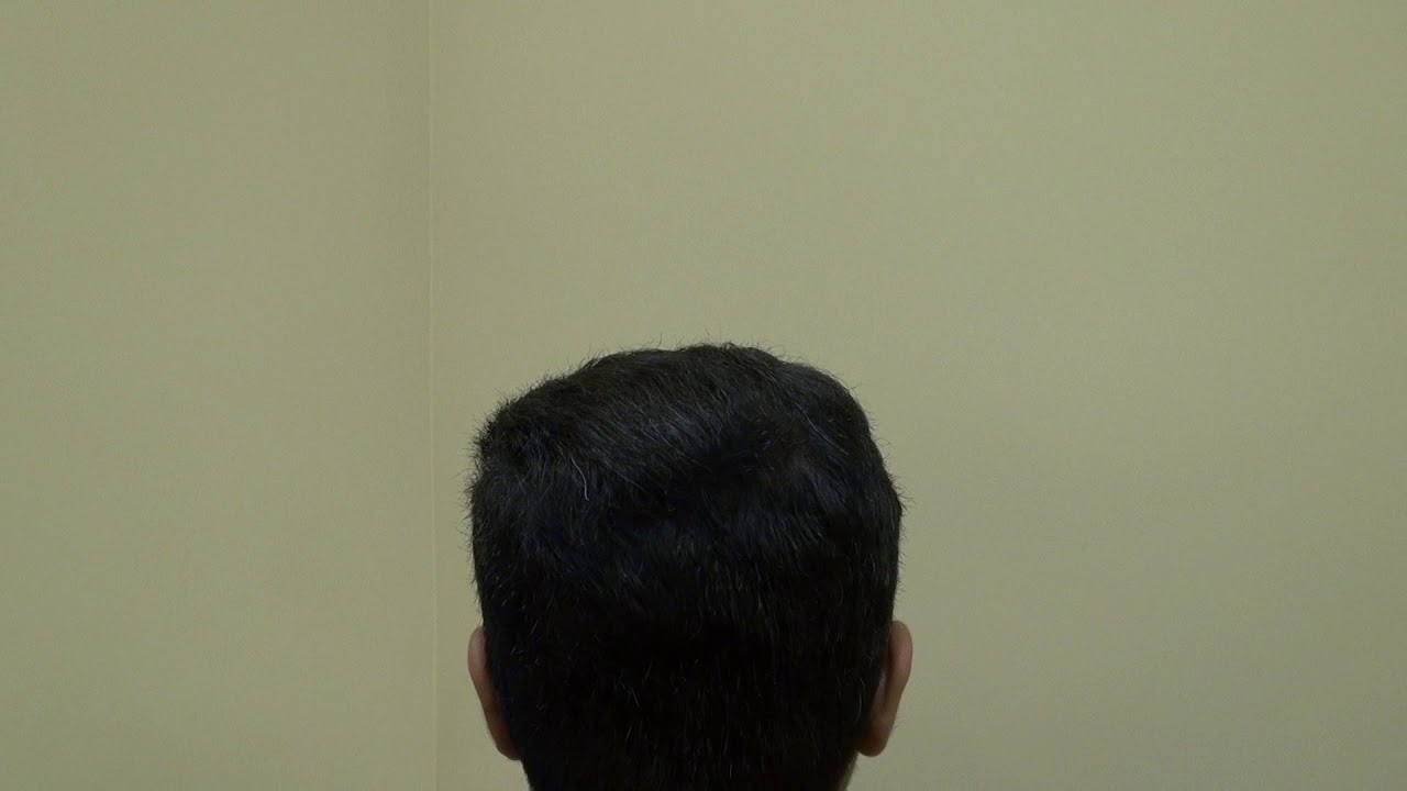 One Year Post Op FUE Crown Vertex Balding Area Hair Loss Results by Dr ...