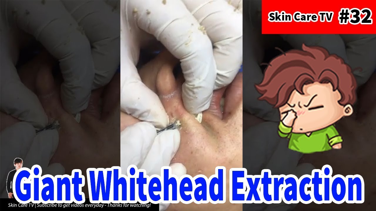 Guide to remove blackheads, acne, pimple in face skin - Pull out ...