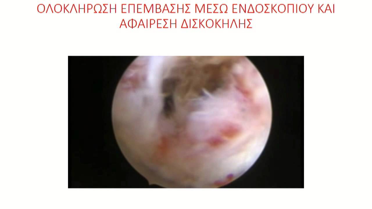 ΕΝΔΟΣΚΟΠΙΚΗ ΔΙΣΚΕΚΤΟΜΗ - YouTube