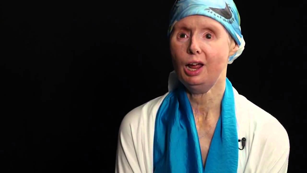 Charla Nash, Victim of Chimpanzee Attack, Speaks Out for Primate Safety ...