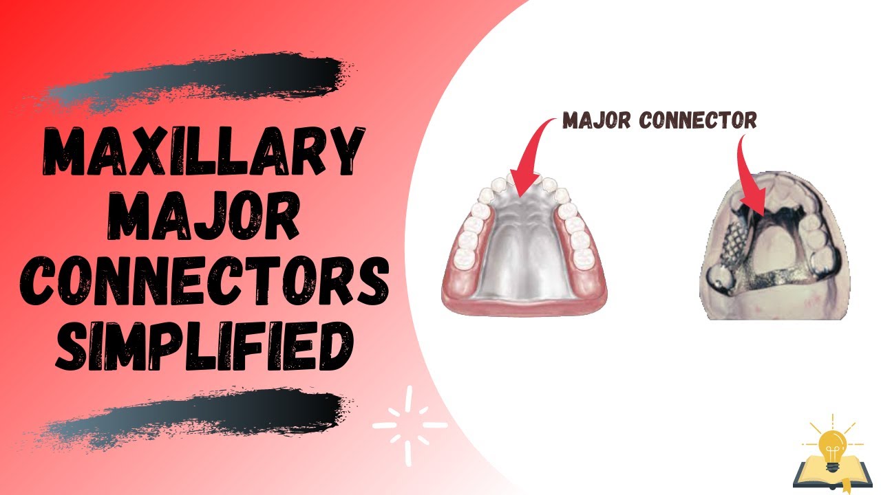 Maxillary Major Connectors | Removable Partial Denture (RPD) - YouTube