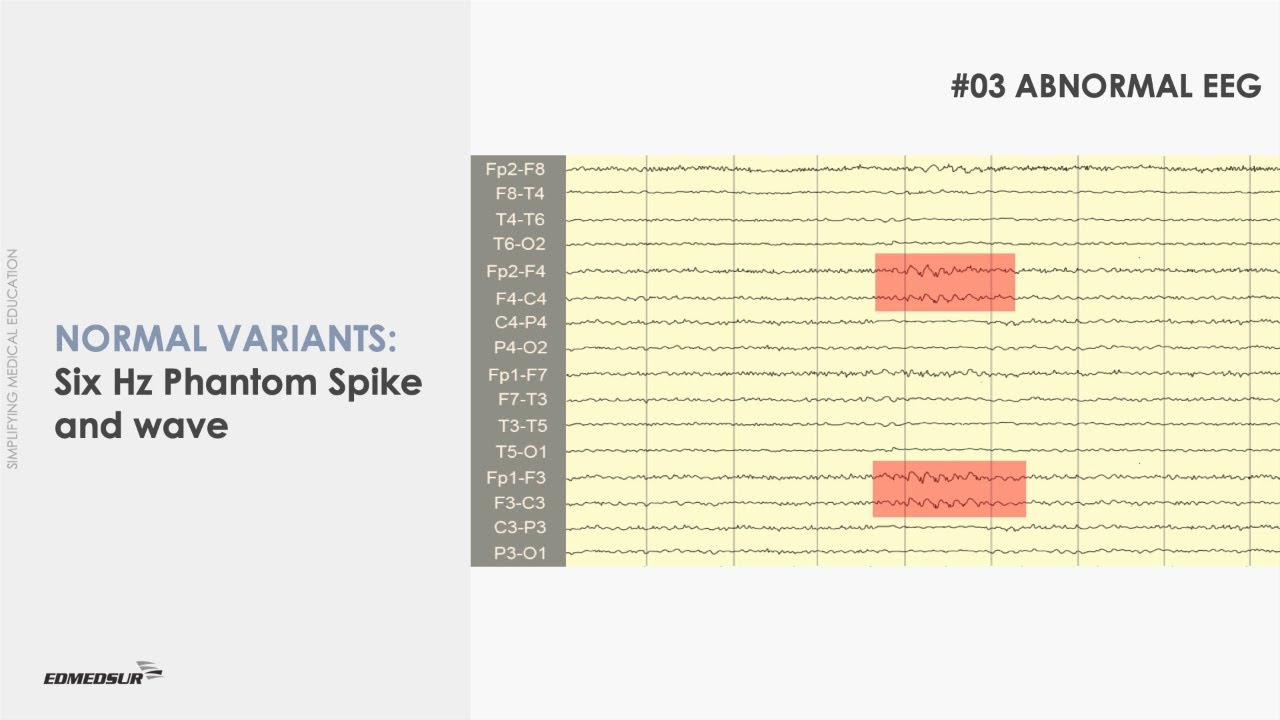 Normal Eeg In Teenager