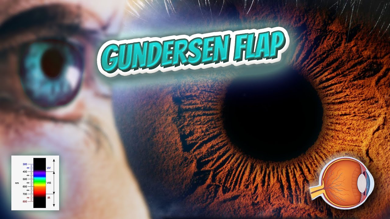 Gundersen flap (Your EYEBALLS) 👁️👁️💉😳💊🔊💯 - YouTube