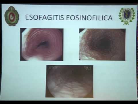 Esofagitis eosinofílica - YouTube