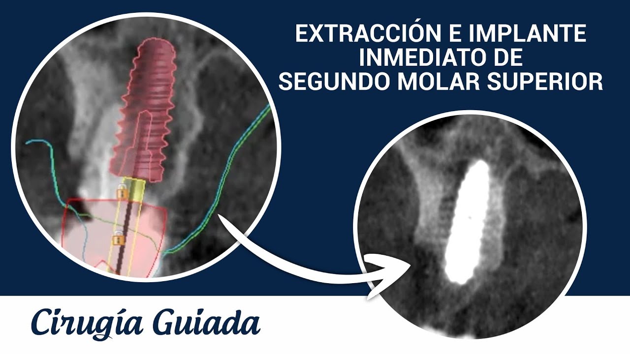 CIRUGIA GUIADA: Extracción e implante inmediato de segundo molar ...