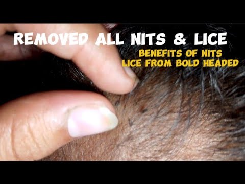 Benefits of Nits & Lice in Bold Headed - Remove thousand lice & Nits ...