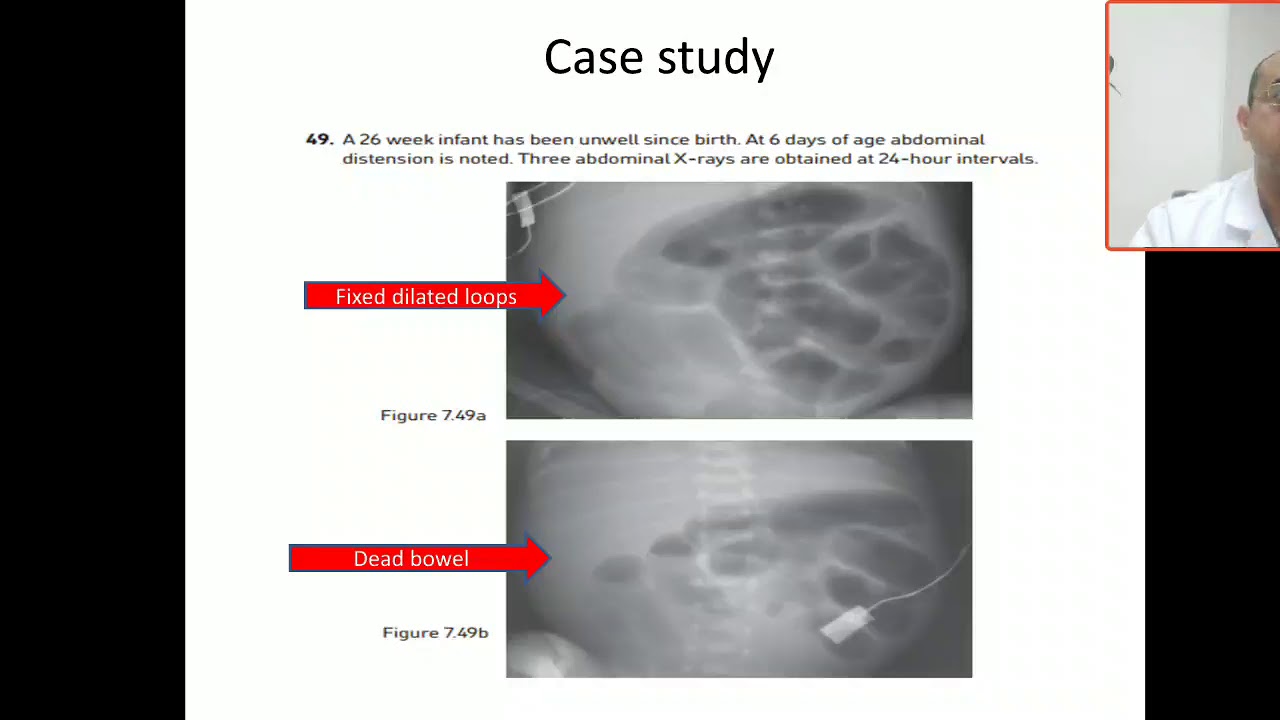 Case 128 fixed dilated bowel indicate dead bowel, NEC ,necrotising ...
