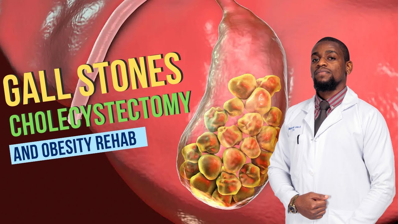 Gall Stones, Cholecystectomy and Obesity Treatment with Evans Mwaniki ...