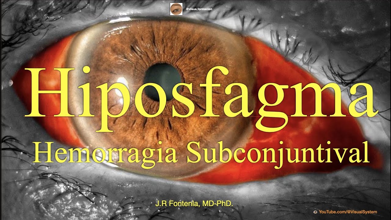 Hiposfagma. Hemorragia Subconjuntival. - YouTube