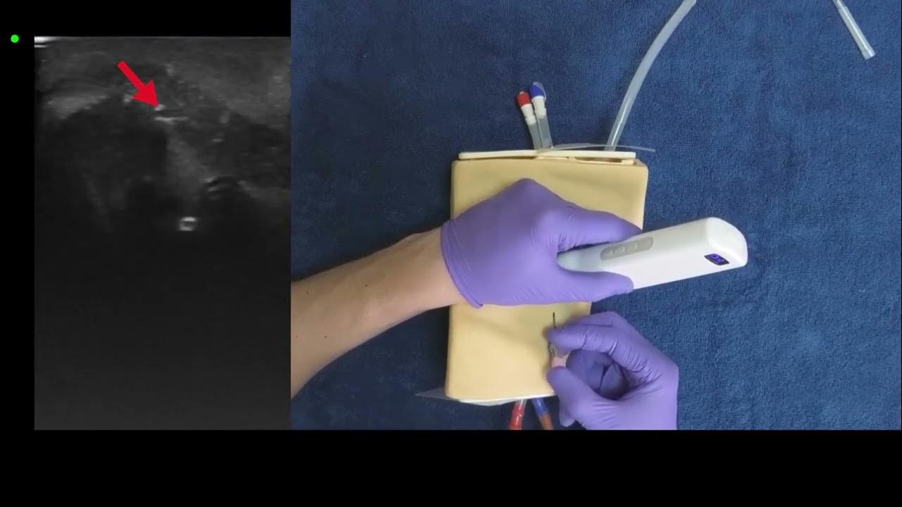 Техники визуализации иглы на УЗИ | IN and OUT of plane ULTRASOUND ...