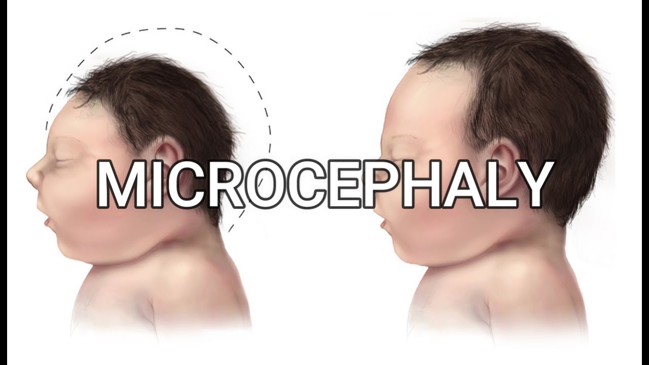 microcephaly - YouTube