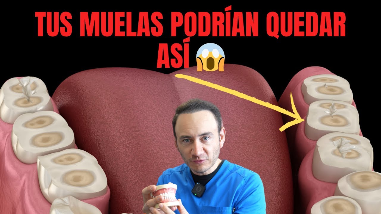 ¿Cómo saber si tus muelas sufrirán de desgaste? - YouTube