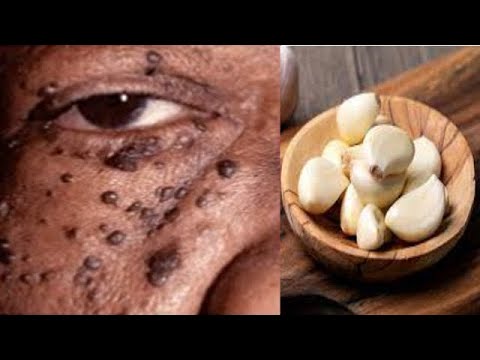 Use GARLIC for 3 days remove skin tag mole and wart - YouTube