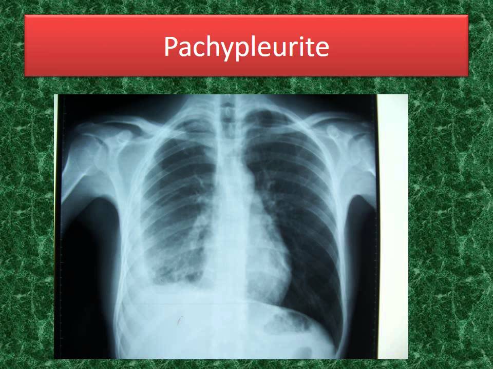 PNEUMOLOGIE images typiques +les interprétation 2015 - YouTube