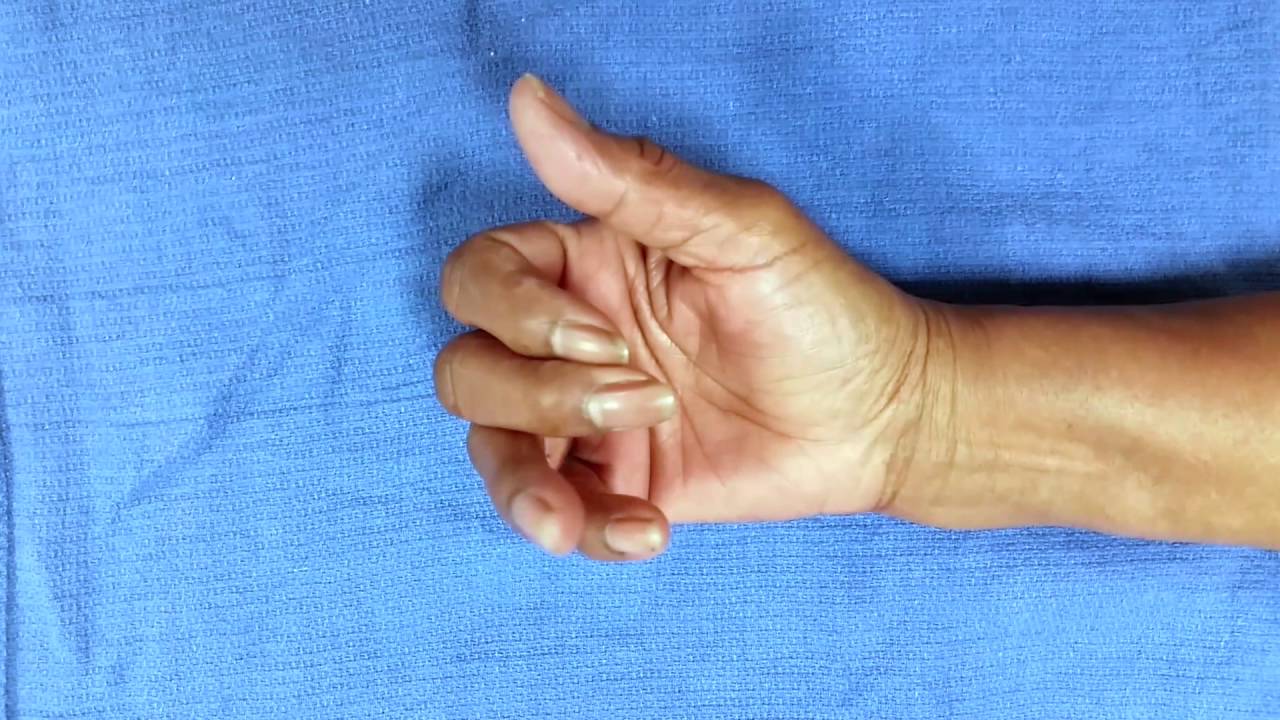 A Surgeon Explains Tigger Finger - YouTube