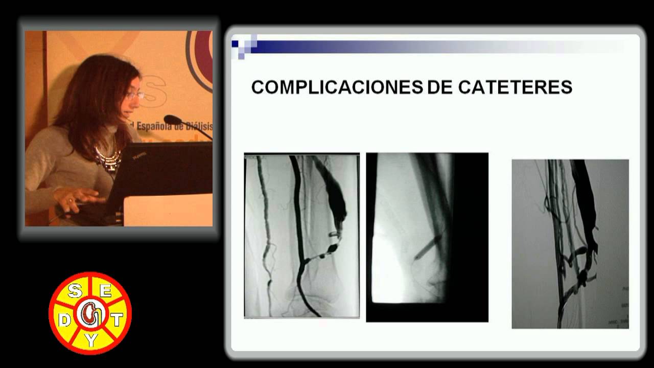 Complicaciones de los catéteres venosos. Accesos Vasculares para ...