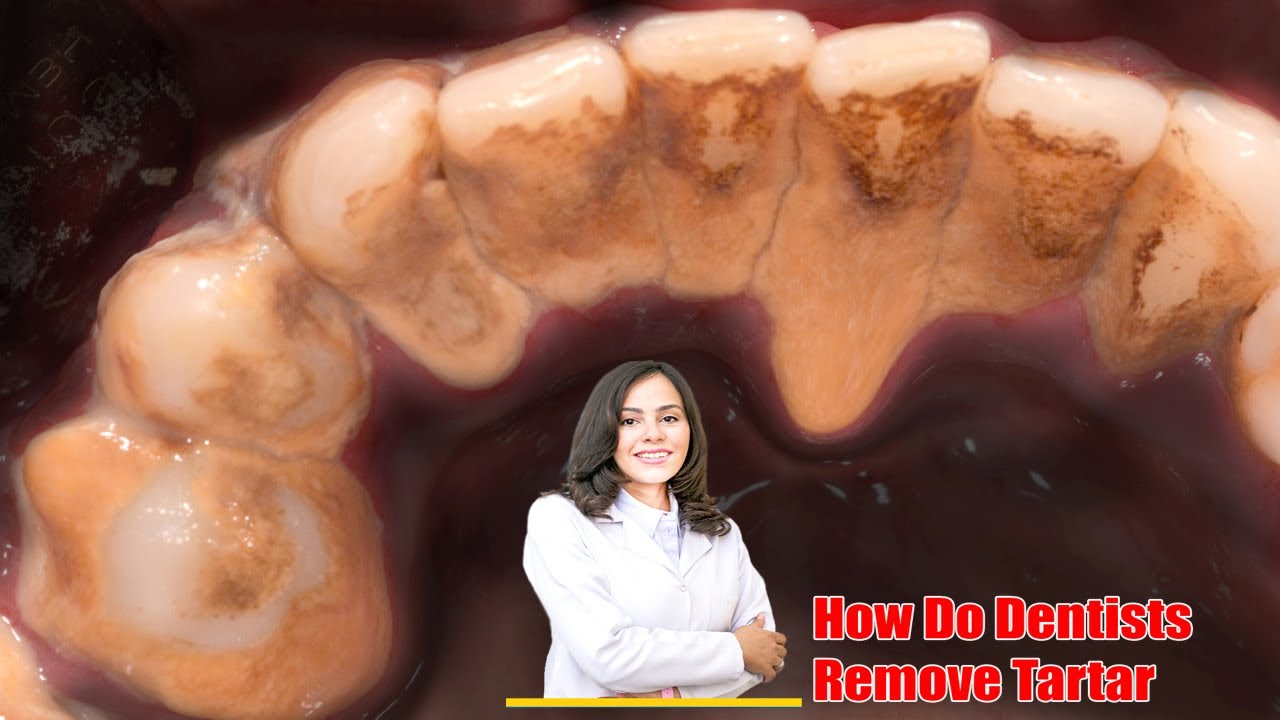 Worst Tartar I have seen! Watch how we remove it! 25 yo FEMALE ...